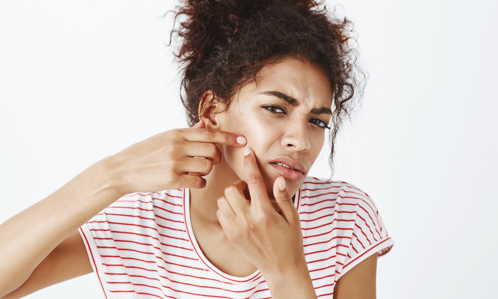 Memahami Jenis Jerawat Dan Penanganannya