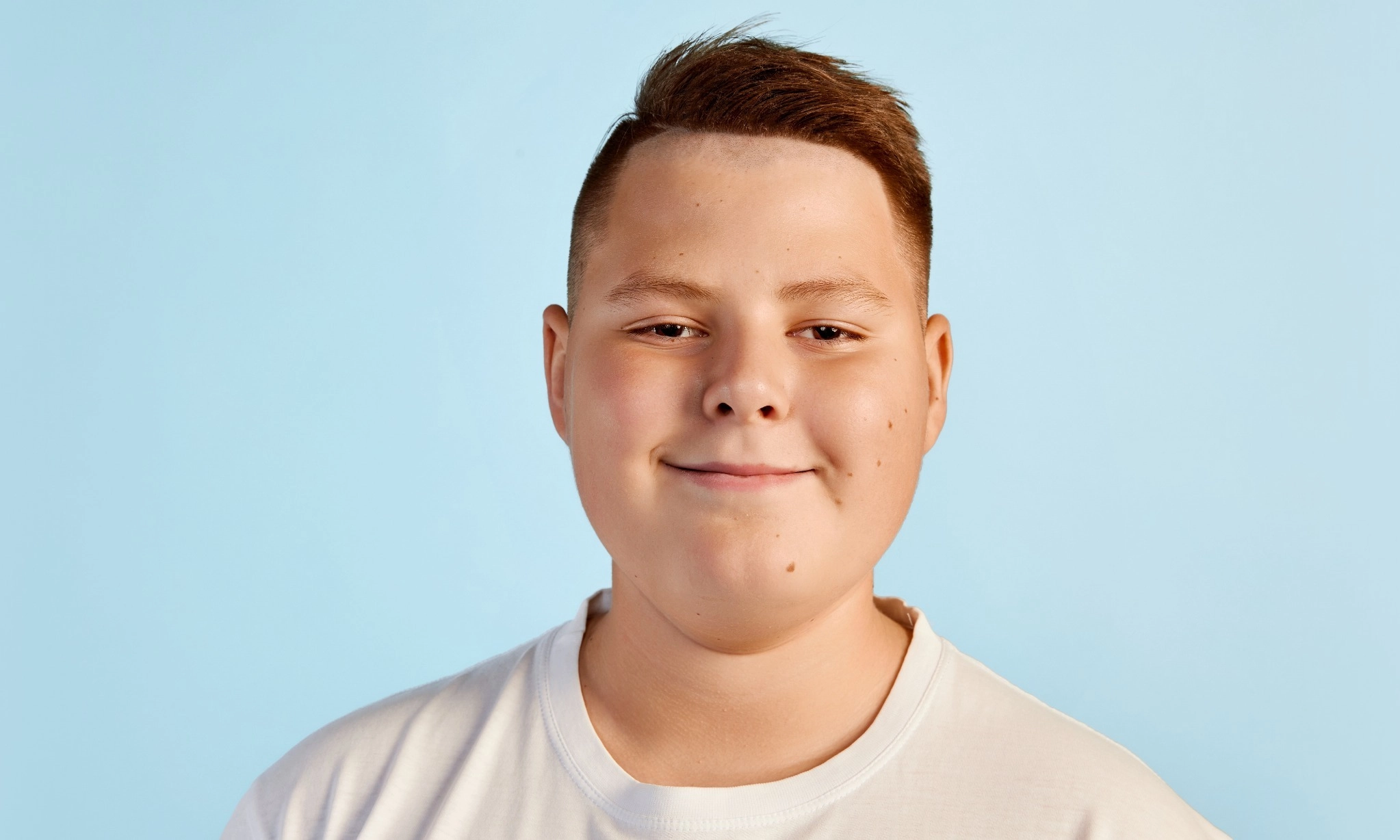 Moon Face Bisa Disebabkan Karena Kadar Hormon Kortisol